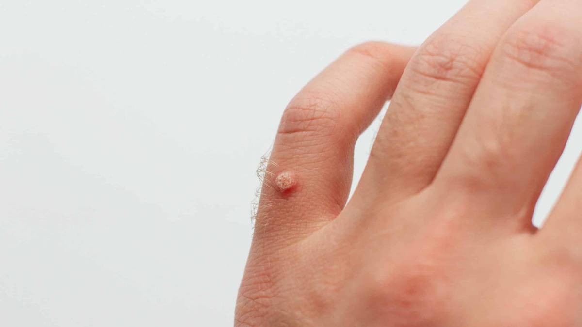 ¿Qué son los cadillos y cómo tratarlos?