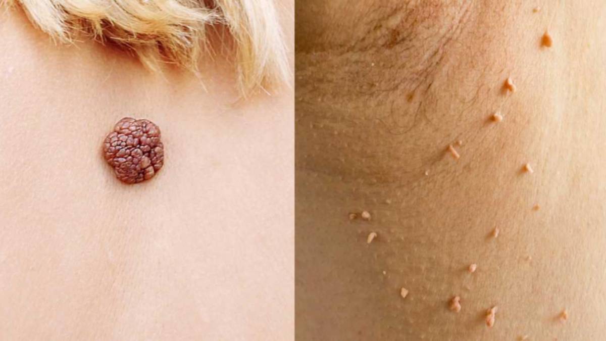 Cómo diferenciar los acrocordones de las verrugas ¡Te lo contamos!